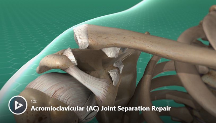 Shoulder Impingement Syndrome (Bursitis or Tendonitis) | Orthopedists ...
