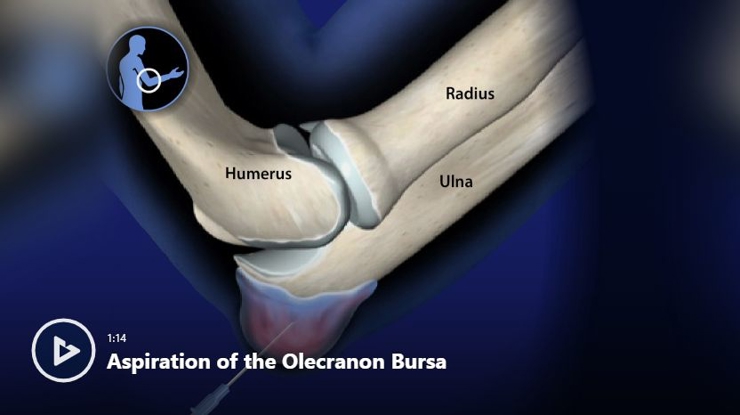 Medial Epicondylectomy Video | Newport Orthopedic Institute