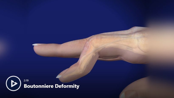 Tenosynovectomy Wrist Surgery | OC Wrist Surgeons