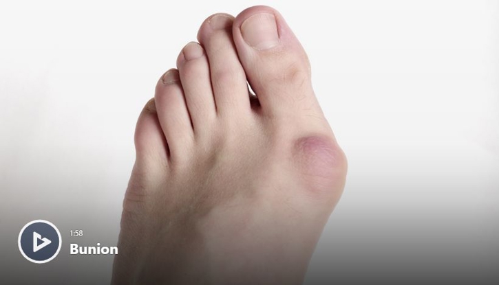 Bunionette Deformity (Tailor's Bunion) Video | Newport Orthopedic Institute