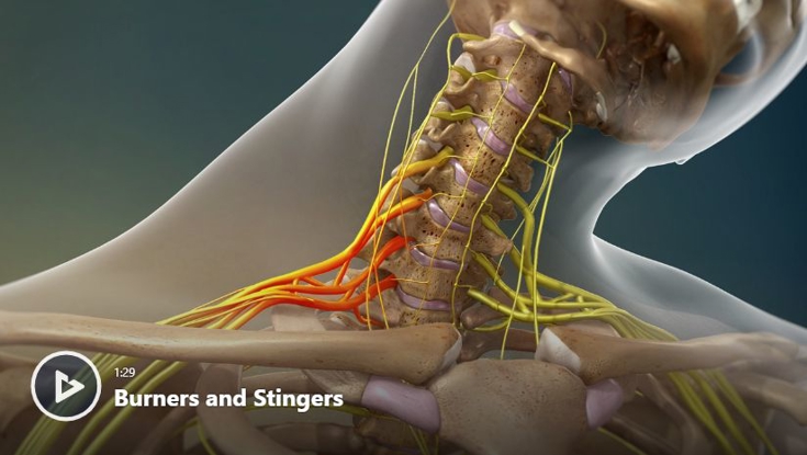 Shoulder Impingement Syndrome (Bursitis or Tendonitis) | Orthopedists ...