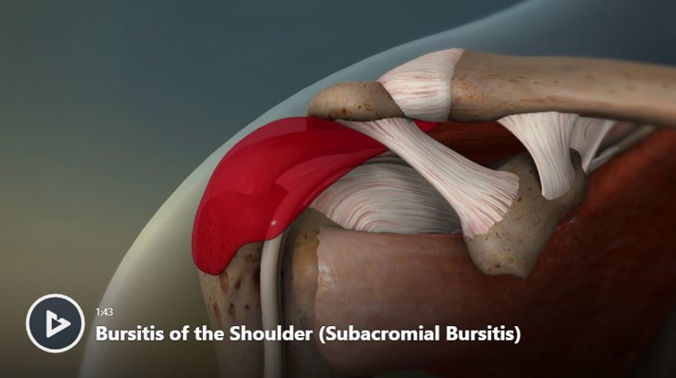 Shoulder Impingement Syndrome (Bursitis or Tendonitis) | Orthopedists ...