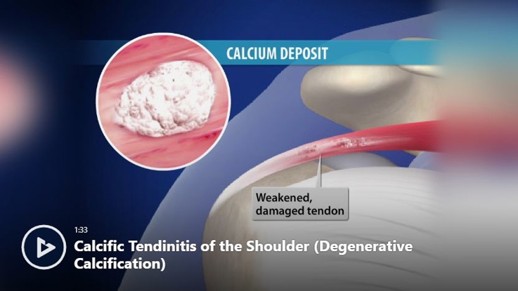 Shoulder Impingement Syndrome (Bursitis or Tendonitis) | Orthopedists ...