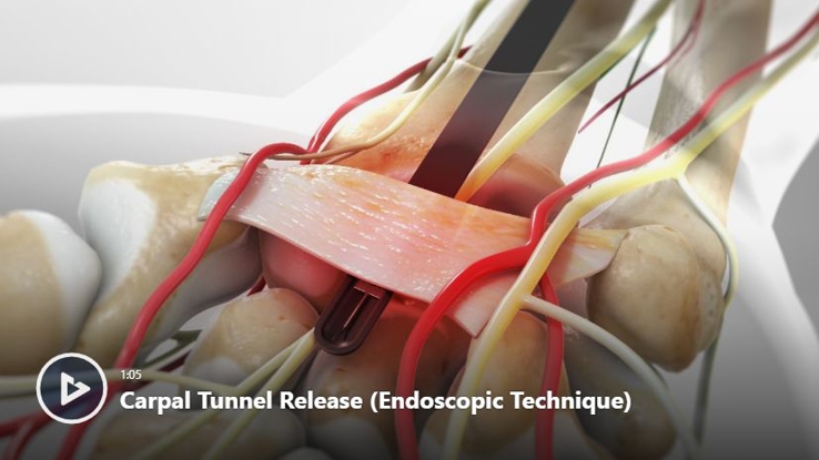 Tenosynovectomy Wrist Surgery | OC Wrist Surgeons