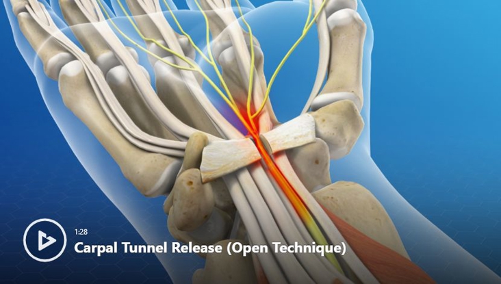 Tenosynovectomy Wrist Surgery | OC Wrist Surgeons