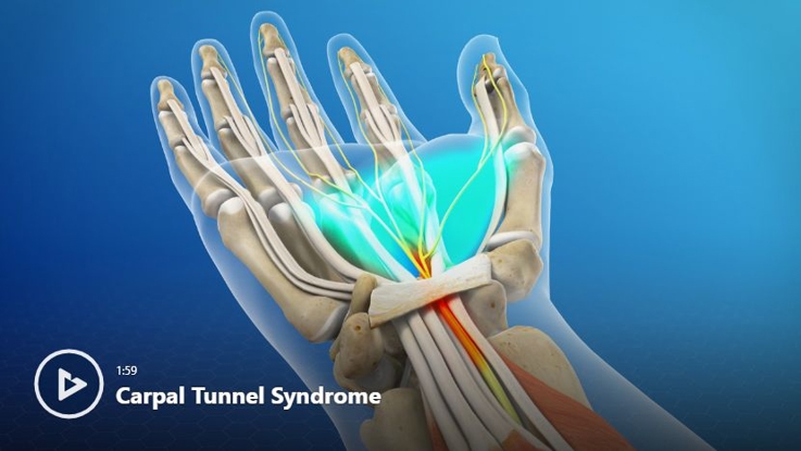 Tenosynovectomy Wrist Surgery | OC Wrist Surgeons