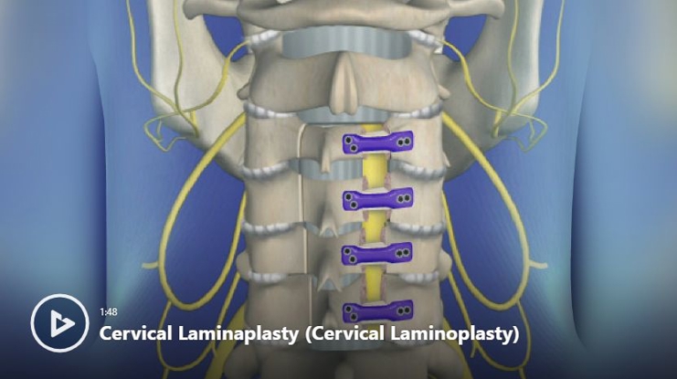Anterior Cervical Corpectomy (Bone Graft) Video | Newport Orthopedic ...