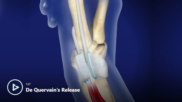 Hand & Wrist Conditions & Treatments | Newport Orthopedic Institute