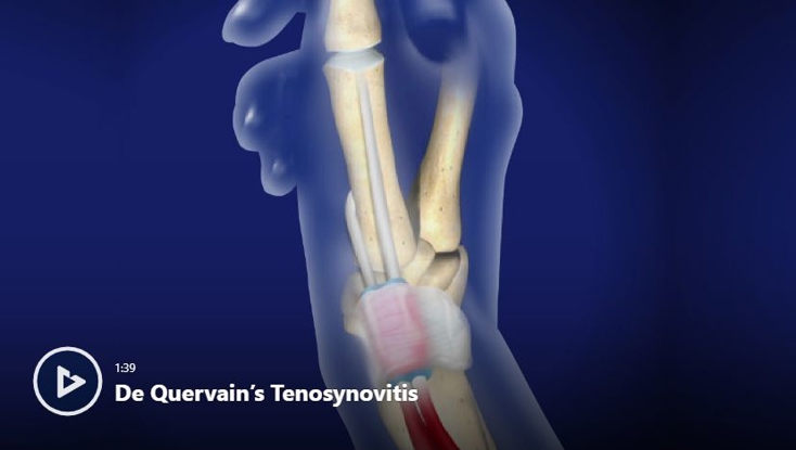 Tenosynovectomy Wrist Surgery | OC Wrist Surgeons