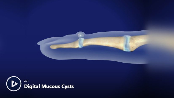 Tenosynovectomy Wrist Surgery | OC Wrist Surgeons