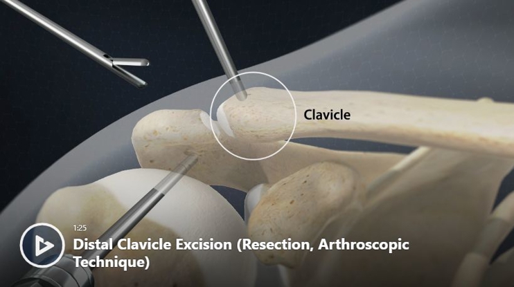 Shoulder Conditions & Treatments Videos | Newport Orthopedic Institute