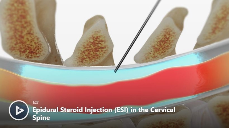 Epidural Steroid Injections in Orange County, CA | Newport Orthopedic ...