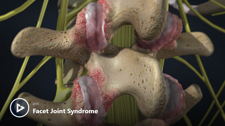 Facet Joint Injections Video | Newport Orthopedic Institute