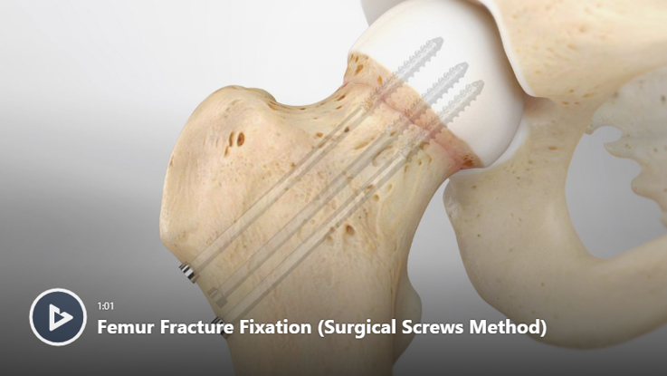 Anterior Hip Replacement in Orange County, CA | Newport Orthopedic ...