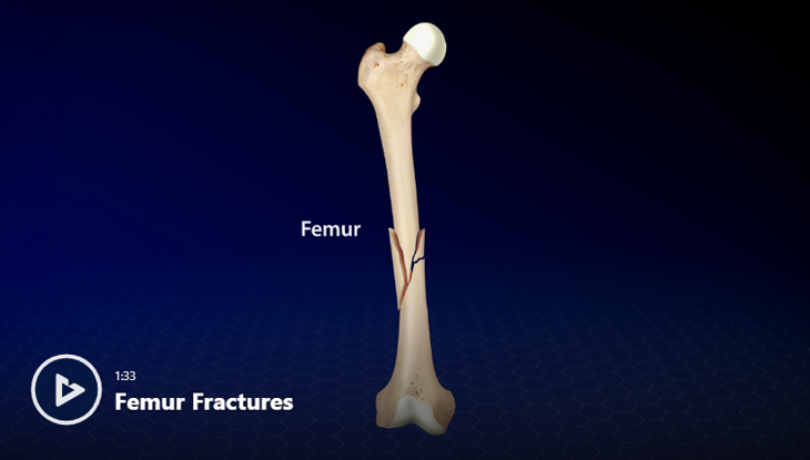 Hip Pain | Newport Orthopedic Institute