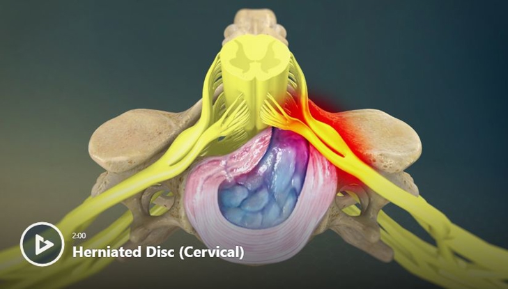 Epidural Steroid Injections in Orange County, CA | Newport Orthopedic ...