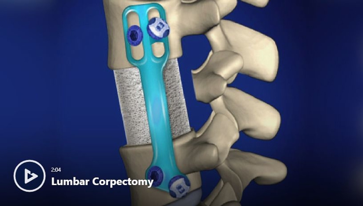 Spine Videos | Newport Orthopedic Institute