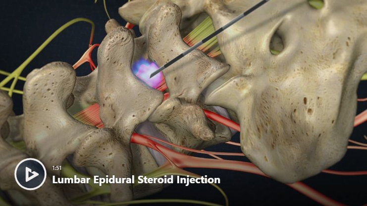 Epidural Steroid Injections in Orange County, CA | Newport Orthopedic ...