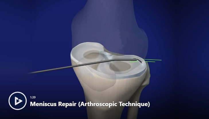 Knee Videos | Newport Orthopedic Institute