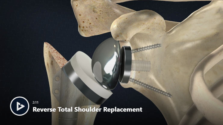 Shoulder Conditions & Treatments Videos | Newport Orthopedic Institute