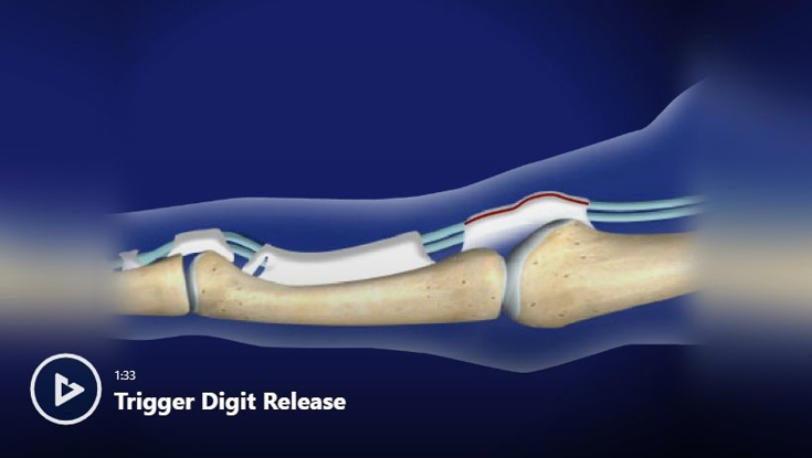 Hand & Wrist Conditions & Treatments Videos | Newport Orthopedic Institute