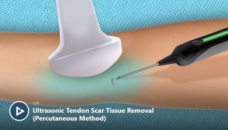 Foot & Ankle Conditions & Treatments Videos | Newport Orthopedic Institute