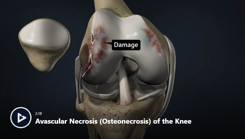 Avascular Necrosis (Osteonecrosis) of the Knee Video | Newport ...