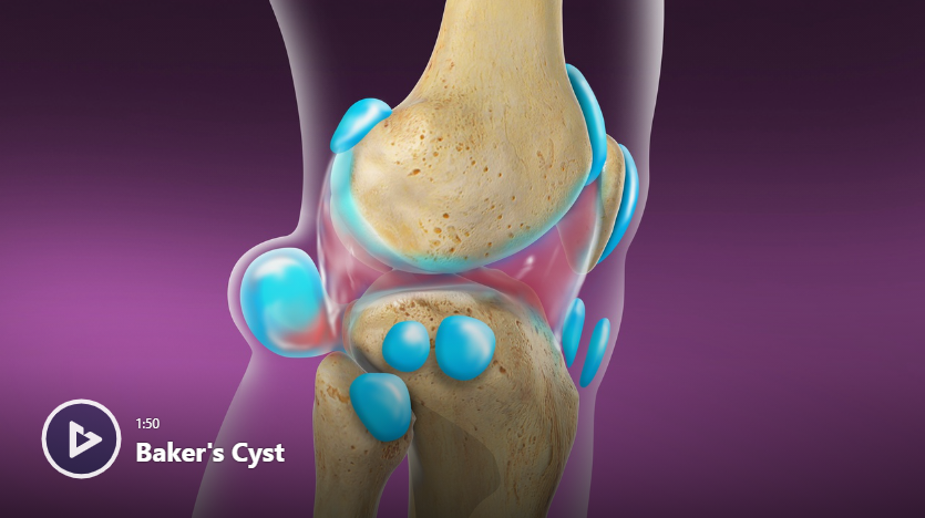 Baker's Cyst Video | Newport Orthopedic Institute