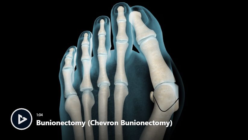 Bunionectomy (Chevron Bunionectomy) Video | Newport Orthopedic Institute