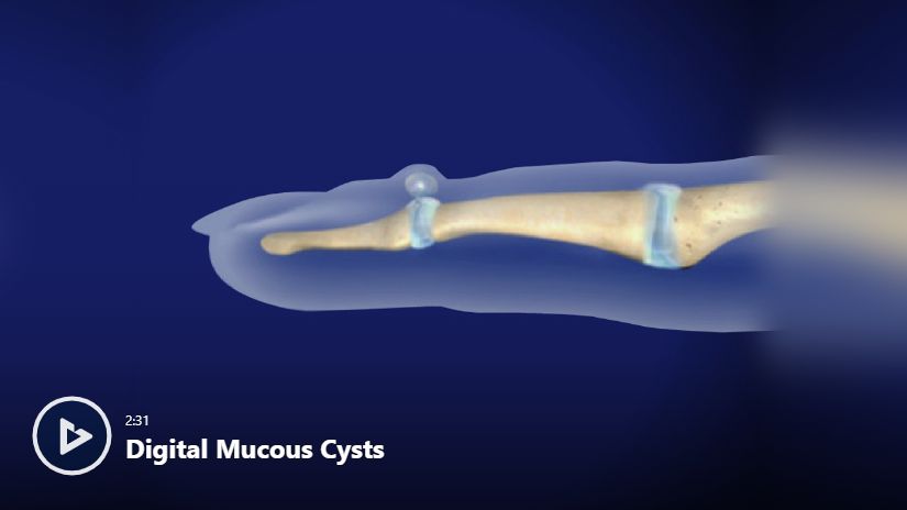 Digital Mucous Cysts Video | Newport Orthopedic Institute