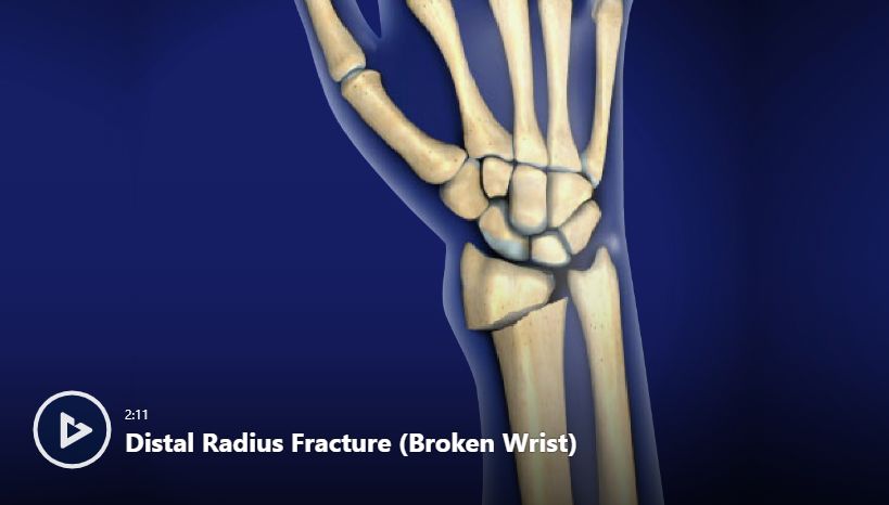 Distal Radius Fracture (Broken Wrist) Video | Newport Orthopedic Institute
