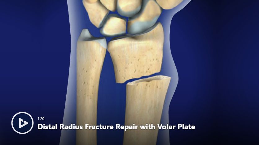 Distal Radius Fracture Repair with Volar Plate Video | Newport ...