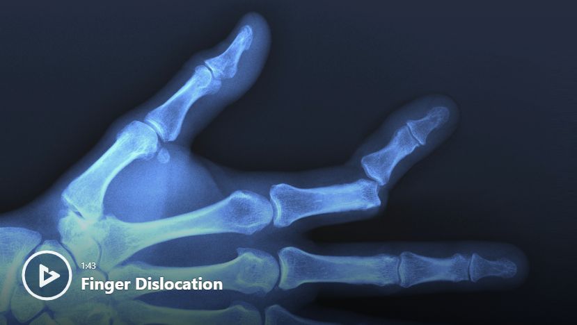 Finger Dislocation Video | Newport Orthopedic Institute