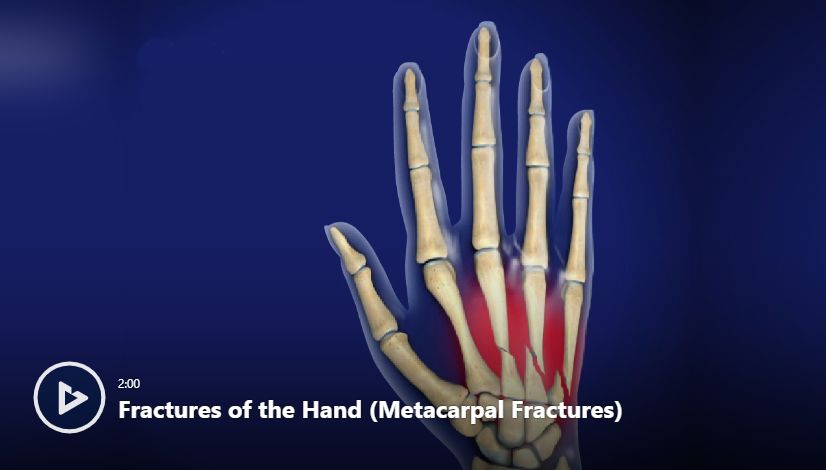 Fractures of the Hand (Metacarpal Fractures) Video | Newport Orthopedic ...