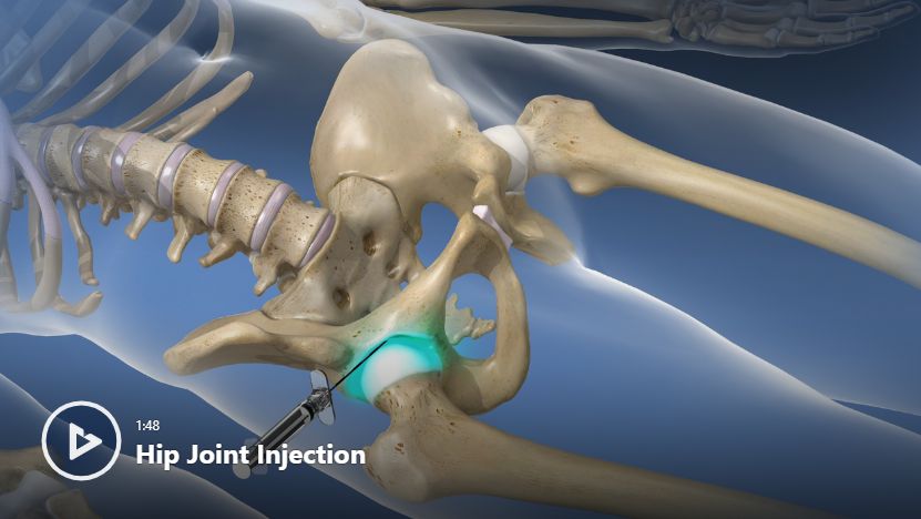 Hip Joint Injection Video | Newport Orthopedic Institute