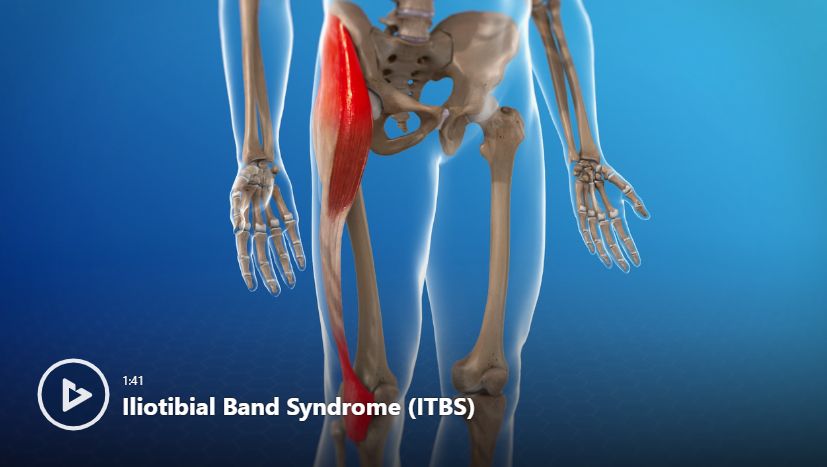 Iliotibial Band Syndrome (ITBS) Video | Newport Orthopedic Institute