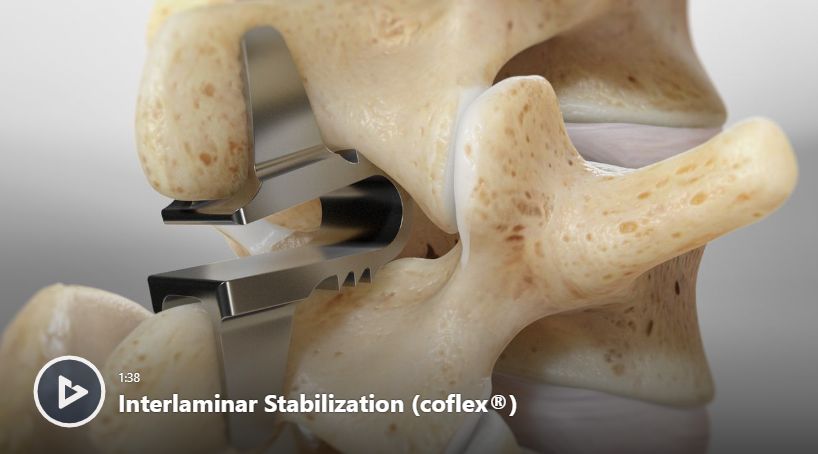 Interlaminar Stabilization (coflex®) Video | Newport Orthopedic Institute