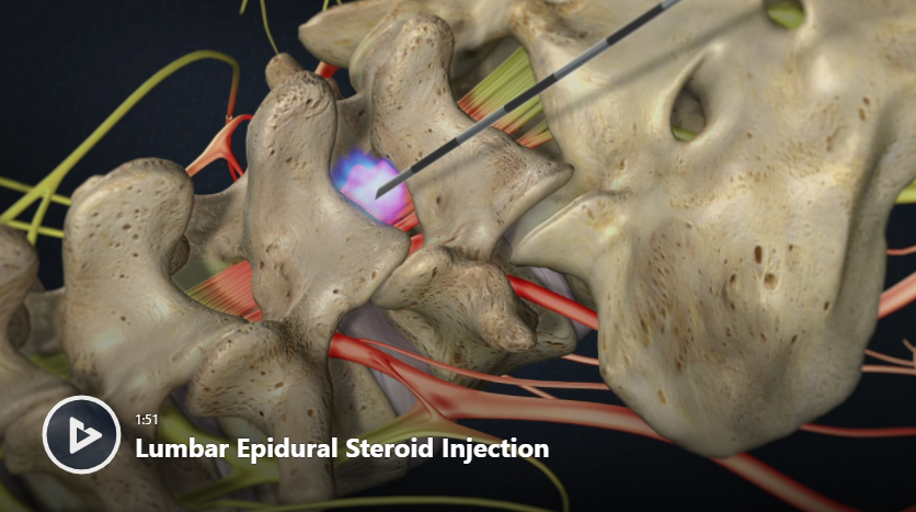 Lumbar Epidural Steroid Injection Video | Newport Orthopedic Institute