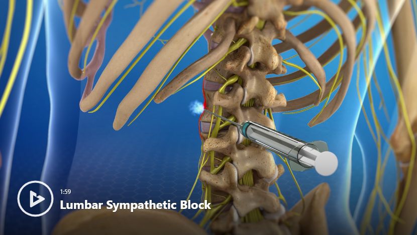 Lumbar Sympathetic Block Video Newport Orthopedic Institute 0886