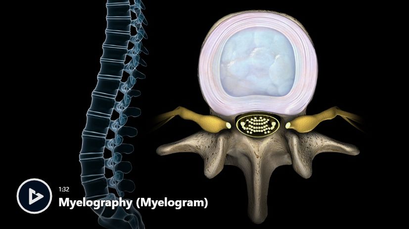 Myelography (Myelogram) Video | Newport Orthopedic Institute