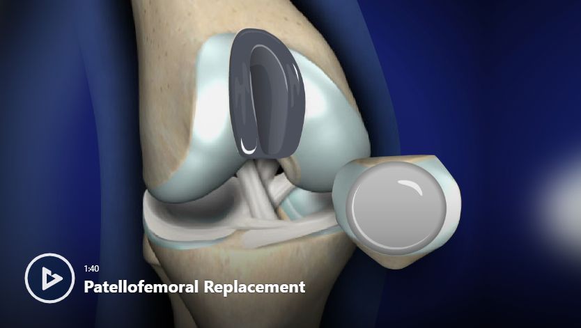 Patellofemoral Replacement Video | Newport Orthopedic Institute