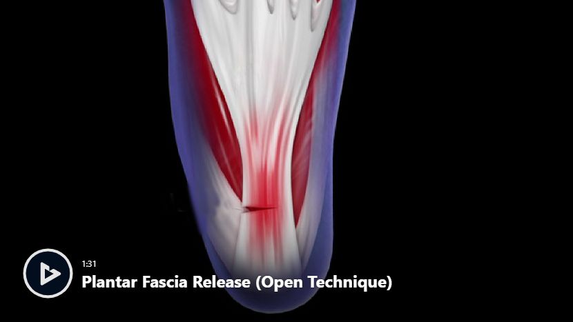 Plantar Fascia Release (Open Technique) Video | Newport Orthopedic ...