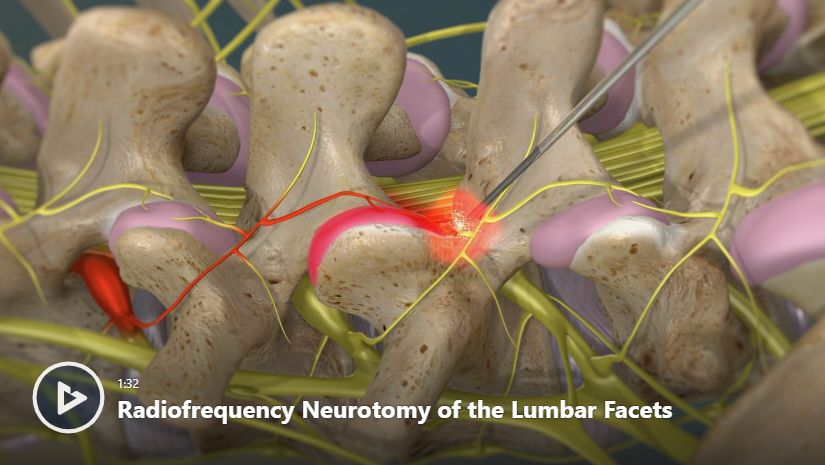Radiofrequency Neurotomy of the Lumbar Facets Video | Newport ...