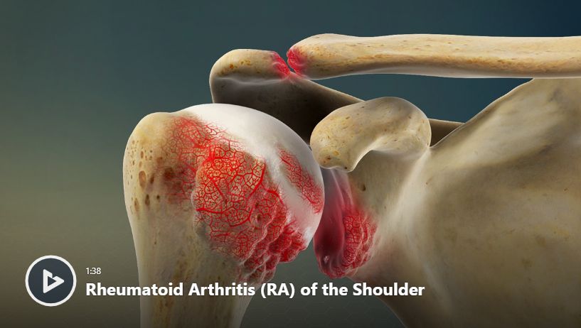 Rheumatoid Arthritis (RA) of the Shoulder Video | Newport Orthopedic ...