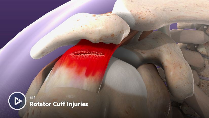Rotator Cuff Injuries Video | Newport Orthopedic Institute
