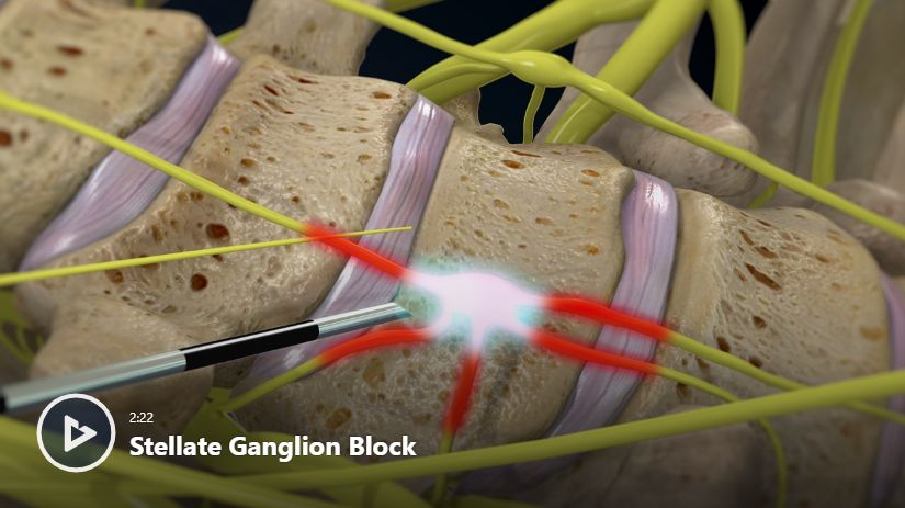 Stellate Ganglion Block Video | Newport Orthopedic Institute