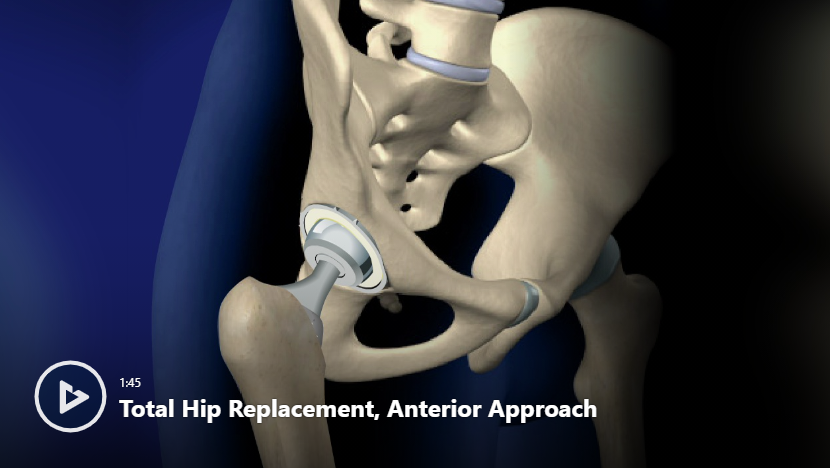 Total Hip Replacement, Anterior Approach Video | Newport Orthopedic ...