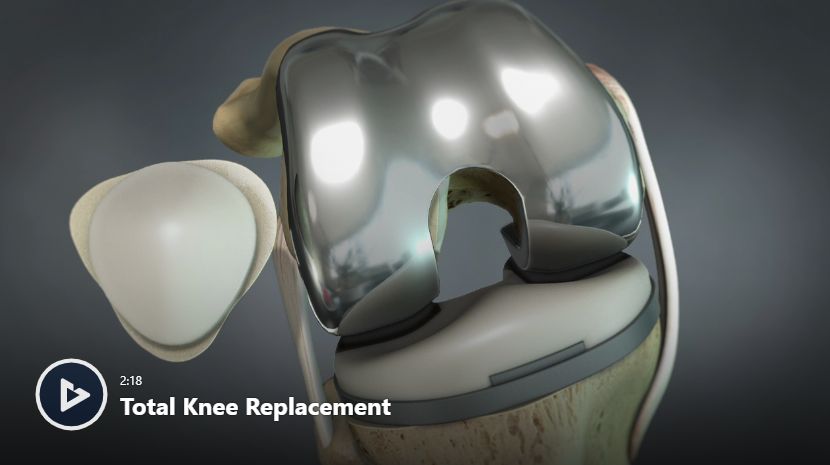 Total Knee Replacement Video | Newport Orthopedic Institute