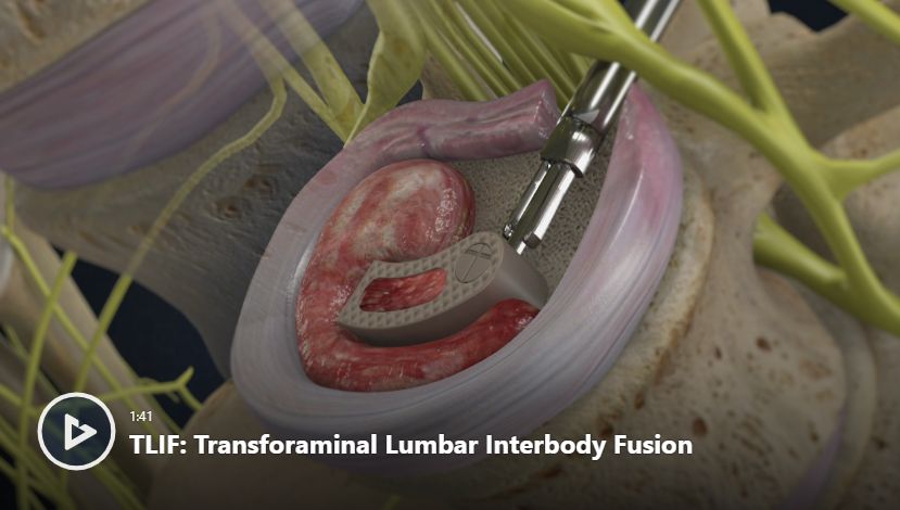 TLIF: Transforaminal Lumbar Interbody Fusion Video | Newport Orthopedic ...
