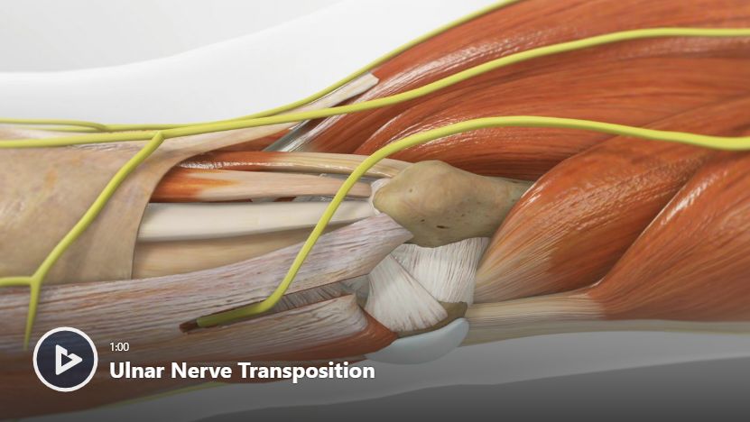 Ulnar Nerve Transposition Video | Newport Orthopedic Institute
